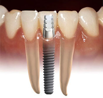 Mengenal proses implan gigi dan prosedurnya | Audy Dental