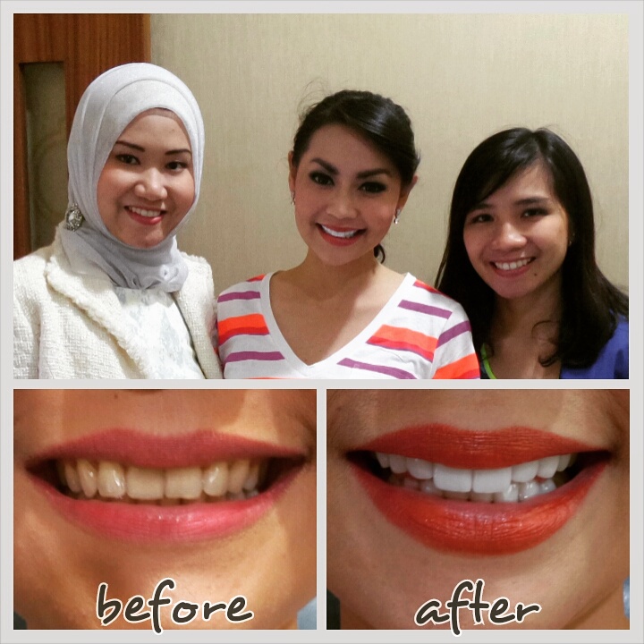 Manfaat dan Biaya Veneer Gigi | Audy Dental