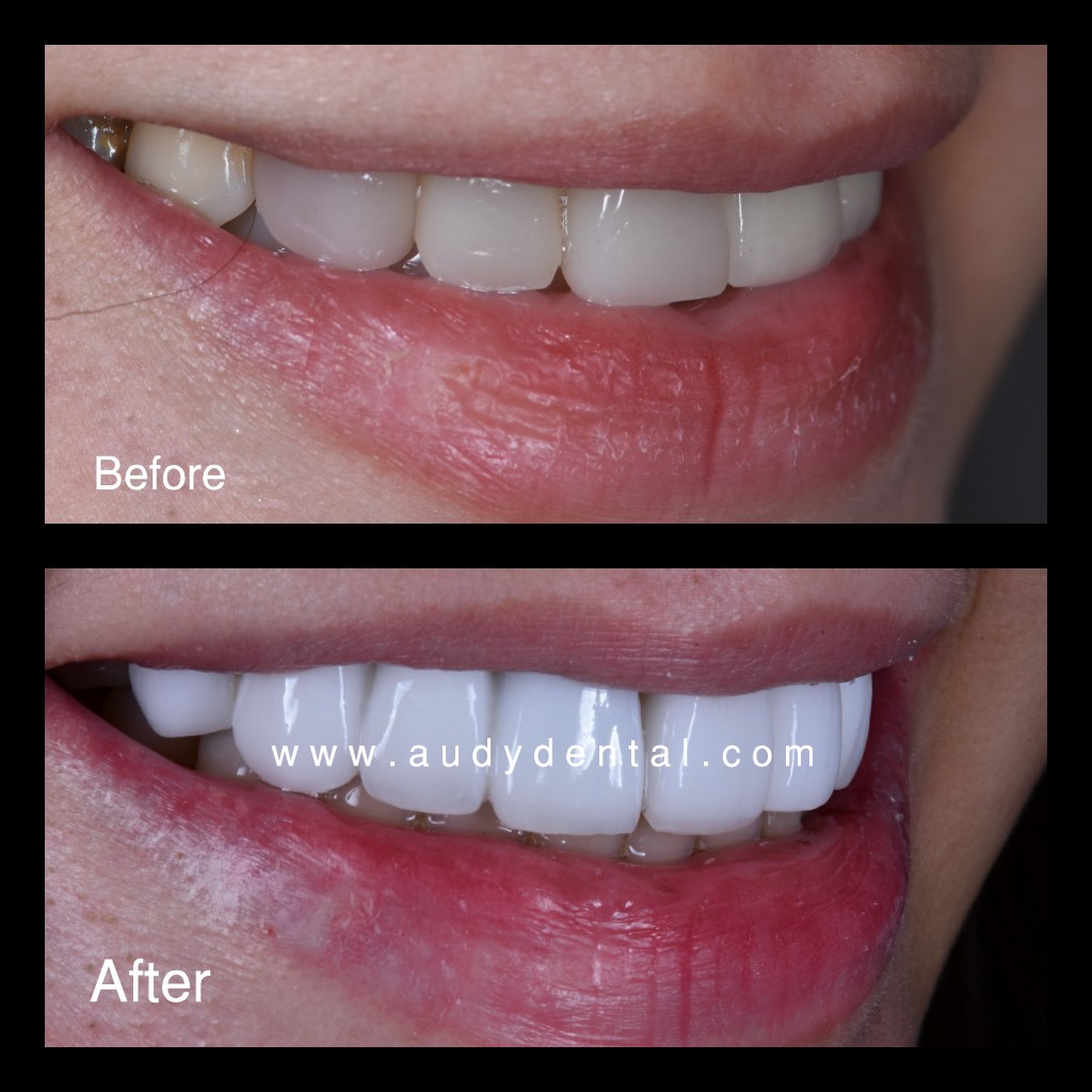 Apa itu Veneer Gigi? Pemasangan & Manfaat Veneer Gigi | Audy Dental