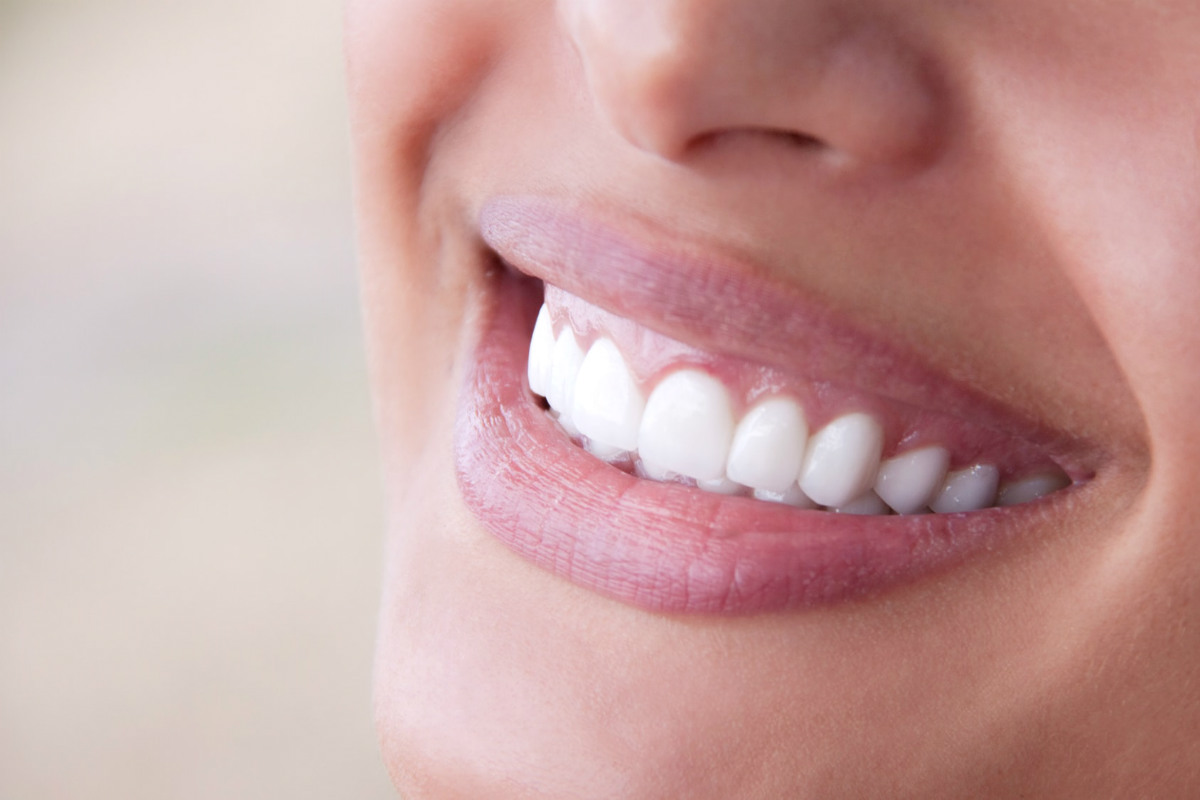 Ini Dia 4 Cara Mudah Untuk Merawat Veneer Gigi | Audy Dental